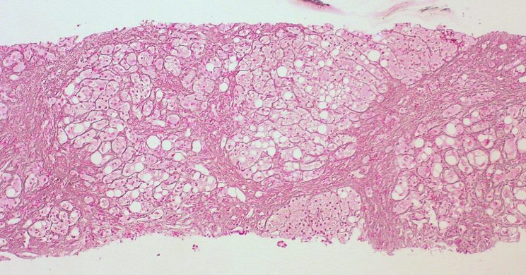 Mutaciones en el gen CIDEB protegen de la enfermedad hepática