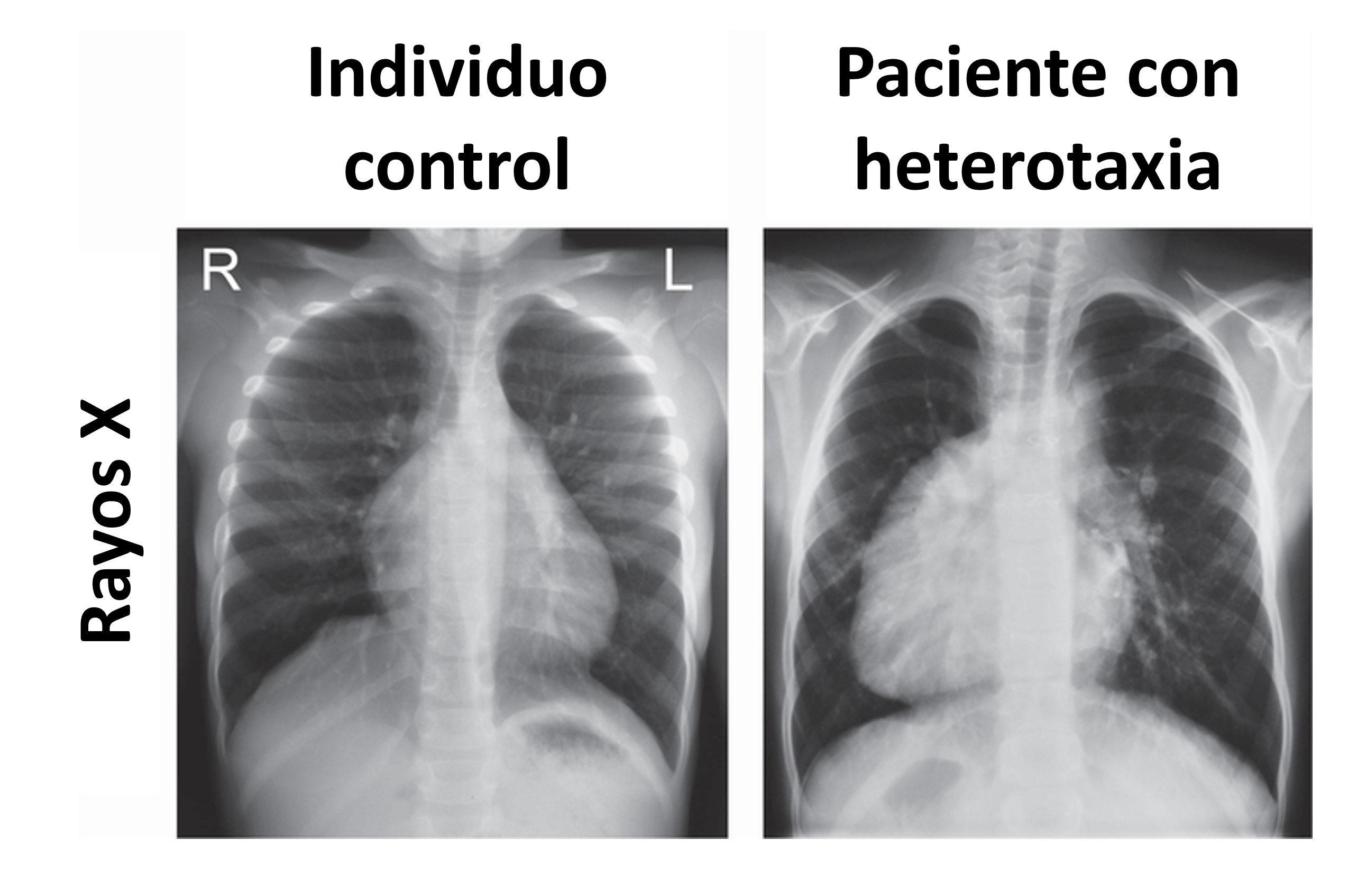heterotaxiab - Genotipia