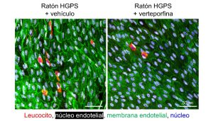 Síndrome de Progeria de Hutchinson-Gilford: Revelan Mecanismo